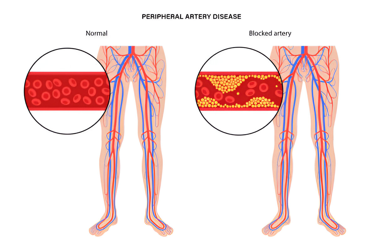 Understanding Atherosclerosis Screening- Carotid Ultrasound, AAA & PAD ...