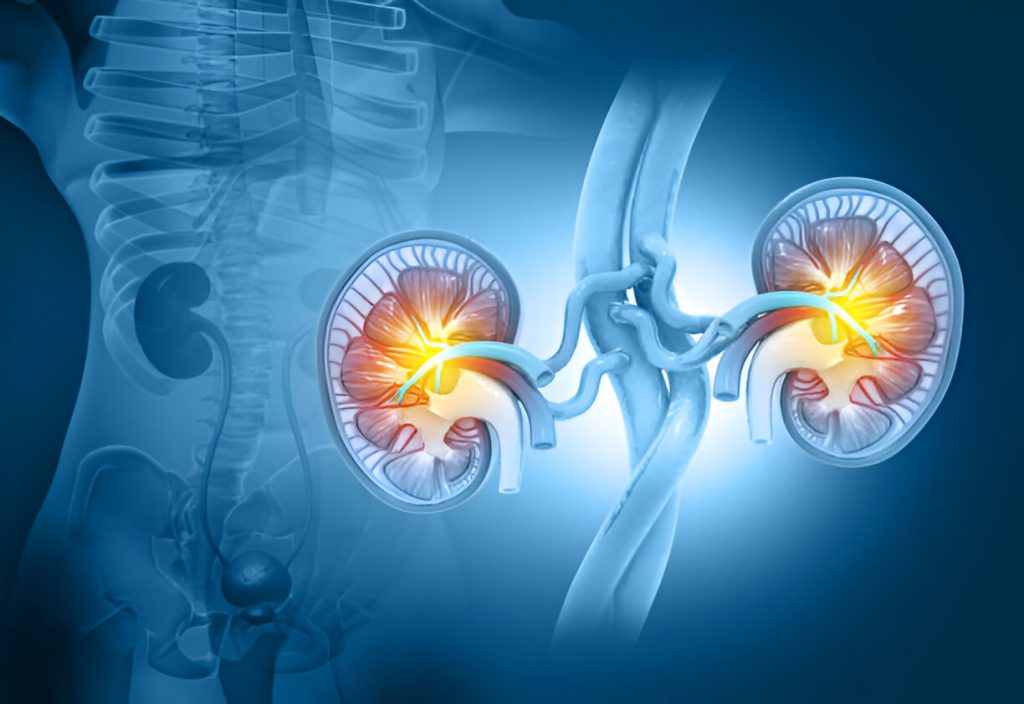 Kidney Stones with Internal Medicine- Pain Relief Solutions